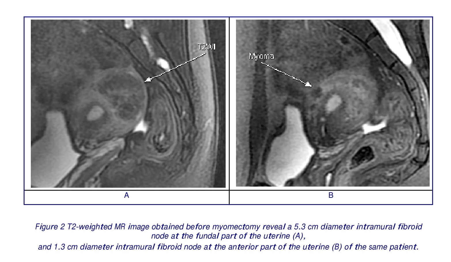 A Randomized, Controlled Study Comparing Isobaric Gasless Laparoscopic ...